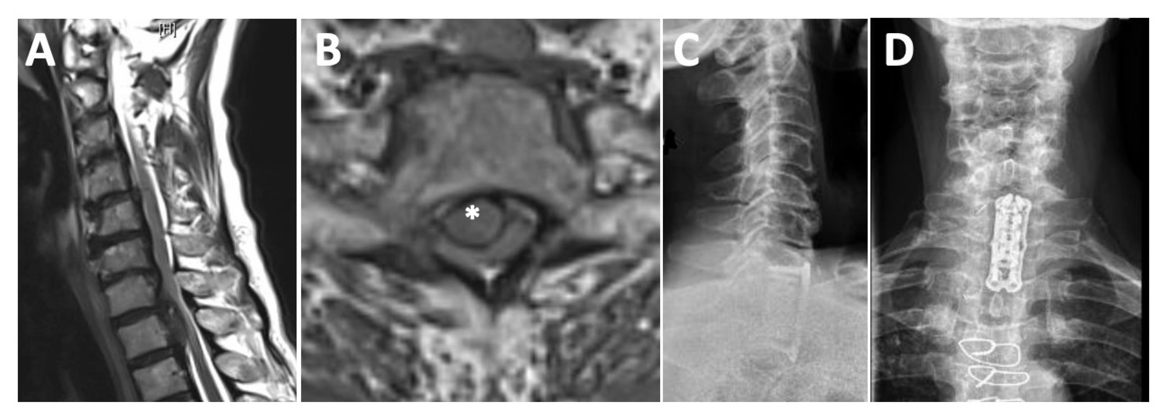 Anterior Access to the Cervicothoracic Junction via Partial Sternotomy ...