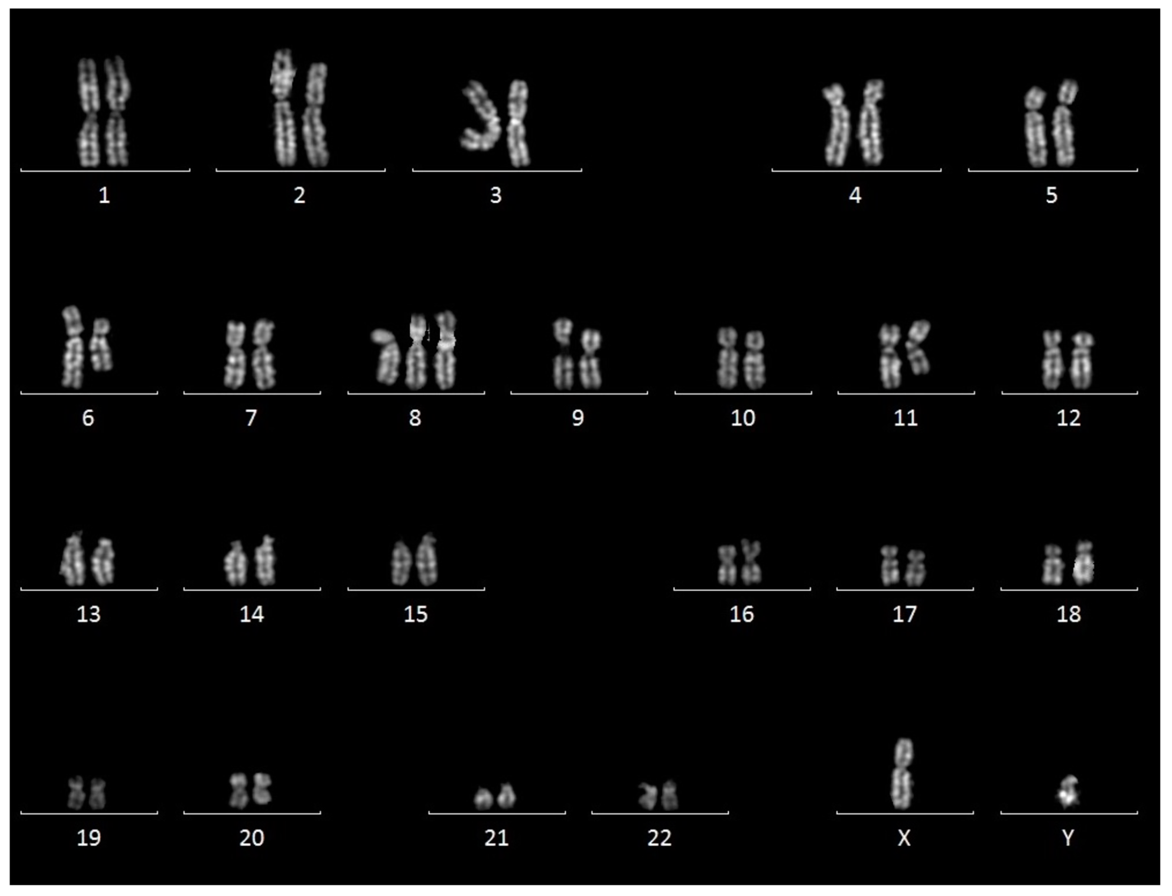A Peculiar CLL Case with Complex Chromosome 6 Rearrangements and Refinement of All Breakpoints ...