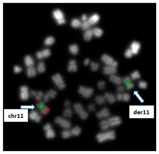 A Peculiar CLL Case with Complex Chromosome 6 Rearrangements and ...