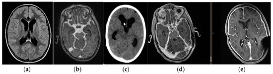 Low- and Negative-Pressure Hydrocephalus: New Report of Six Cases and ...