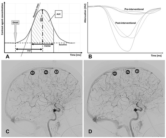 DSA-Based 2D Perfusion Measurements in Delayed Cerebral Ischemia to ...