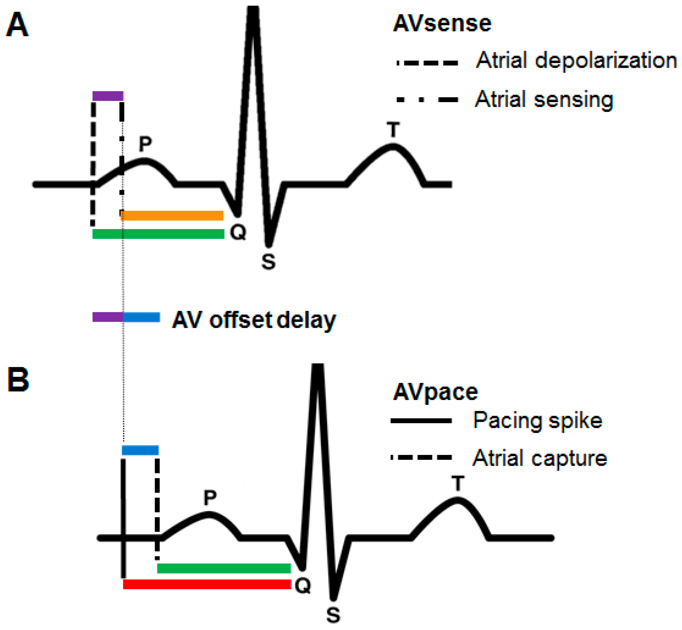 Atrial Depolarization Atrial Depolarization