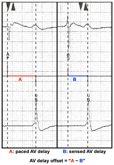 Cardiac Resynchronization Therapy beyond Nominal Settings: An IEGM ...