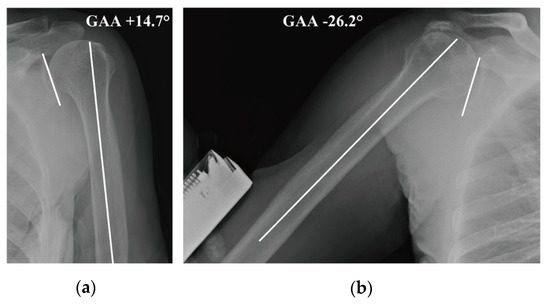 Adduction Manipulation of the Glenohumeral Joint versus Physiotherapy ...
