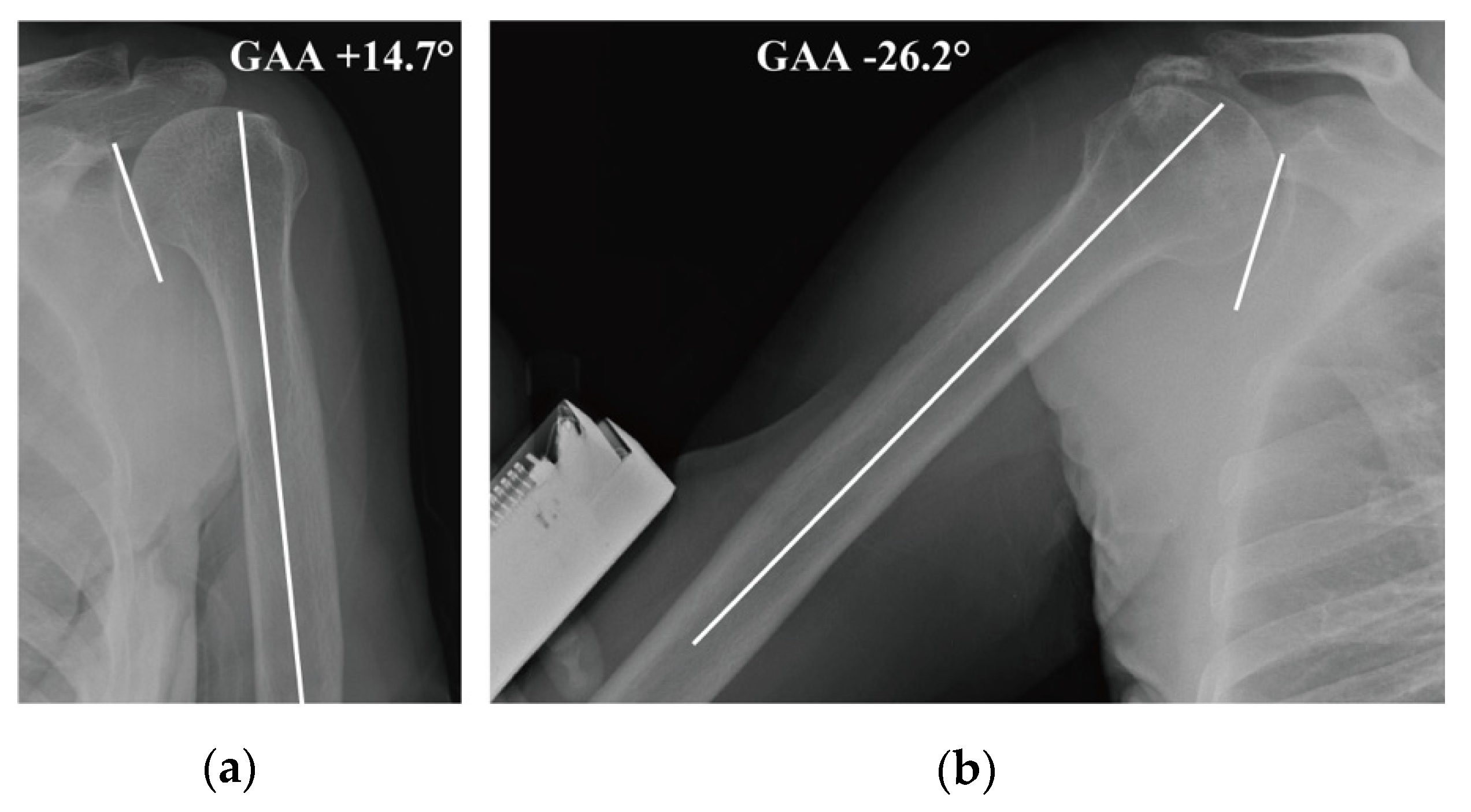 Adduction Manipulation of the Glenohumeral Joint versus Physiotherapy ...