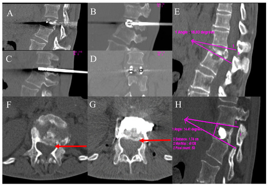 Jcm Free Full Text Percutaneous Vertebral Reconstruction Pvr