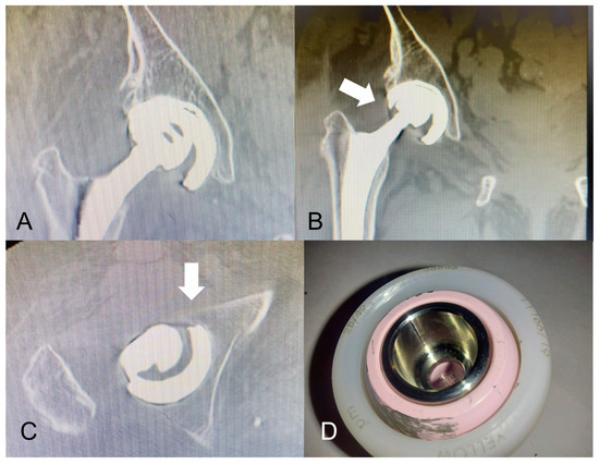 Is Modular Dual Mobility Superior to Standard Bearings for Reducing ...