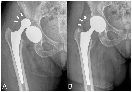 Is Modular Dual Mobility Superior to Standard Bearings for Reducing ...