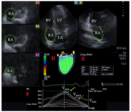 Three-Dimensional Speckle-Tracking Echocardiography-Derived Tricuspid ...