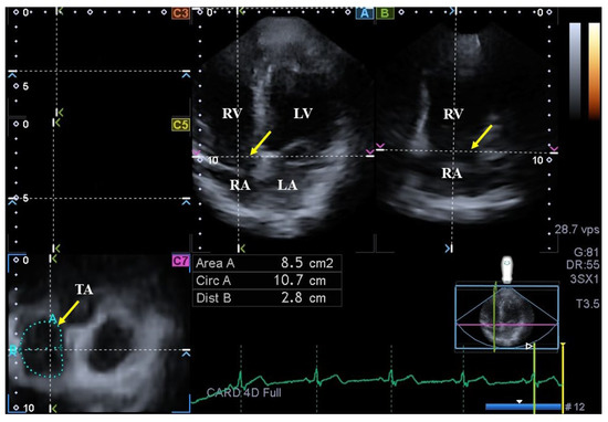 Three-Dimensional Speckle-Tracking Echocardiography-Derived Tricuspid ...