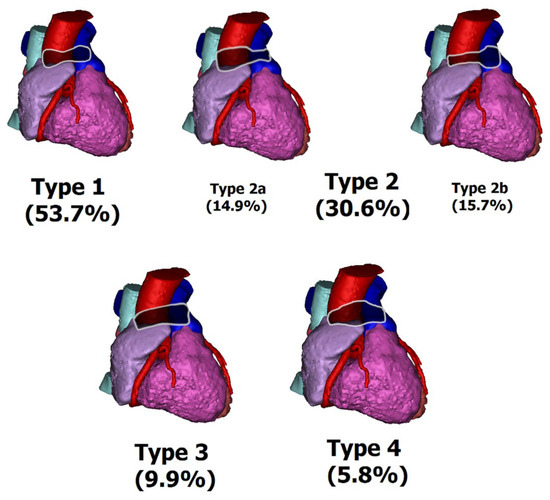 Morphology and Anatomical Classification of Pericardial Cavities ...