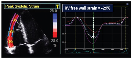 Acute Changes in Right Ventricular Function in Pediatric Patients with ...