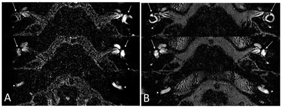 Infliximab for the Treatment of Inflammatory Labyrinthitis: A ...
