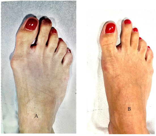 Temporal Changes in Clinical Outcomes after Minimally Invasive Surgery for Hallux Valgus ...