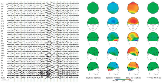 Method for Classifying Schizophrenia Patients Based on Machine Learning