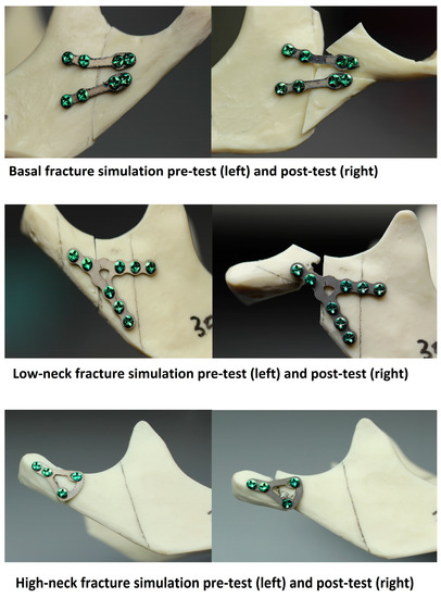 Evaluation of the Relationship of Screw Pullout and Plate Fracutre in ...