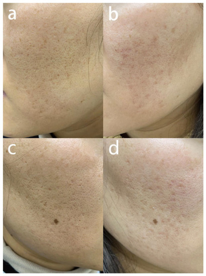“Multiple Mode Procedures” of Ultra-Pulse Fractional CO2 Laser: A Novel ...