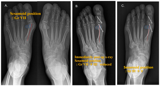 Medial Reduction in Sesamoid Position after Hallux Valgus Correction ...