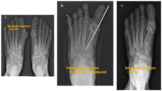Medial Reduction in Sesamoid Position after Hallux Valgus Correction ...