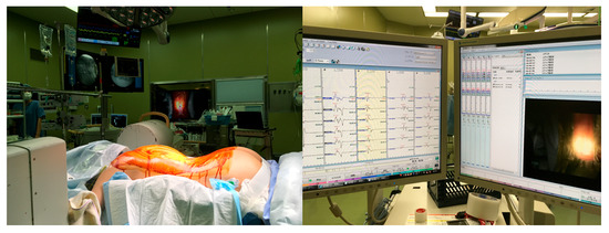 Factors Affecting Transcranial Motor-Evoked Potential Measurements ...
