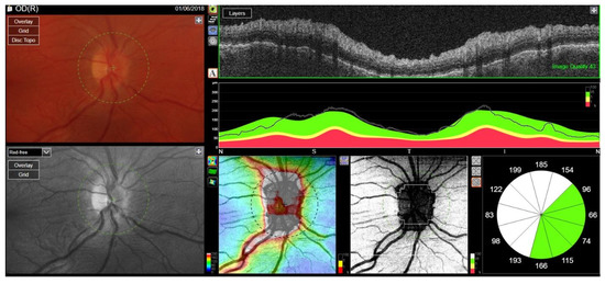 Ocular Involvement of Granulomatosis with Polyangiitis