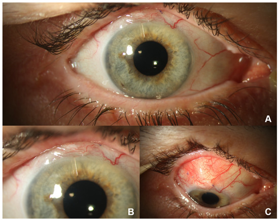 Long-Term Outcomes of the PRESERFLO MicroShunt Implant in a ...