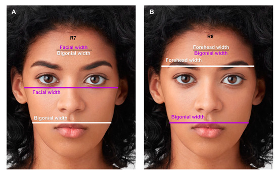 Facial Morphometrics in Black Celebrities: Contemporary Facial Analysis ...