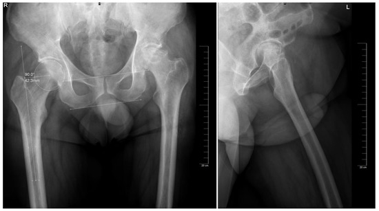 Overall Accuracy of Radiological Digital Planning for Total Hip ...