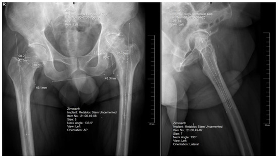 Overall Accuracy of Radiological Digital Planning for Total Hip ...