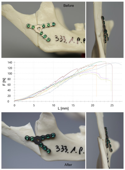 Which of 51 Plate Designs Can Most Stably Fixate the Fragments in a ...