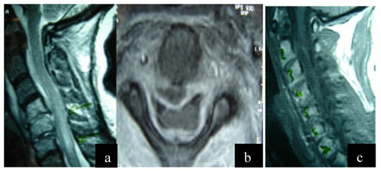 Jcm Free Full Text Cervical Spinal Epidural Abscess Diagnosis