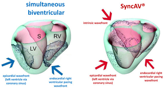 Visualization of the SyncAV® Algorithm for CRT Optimization by Non ...