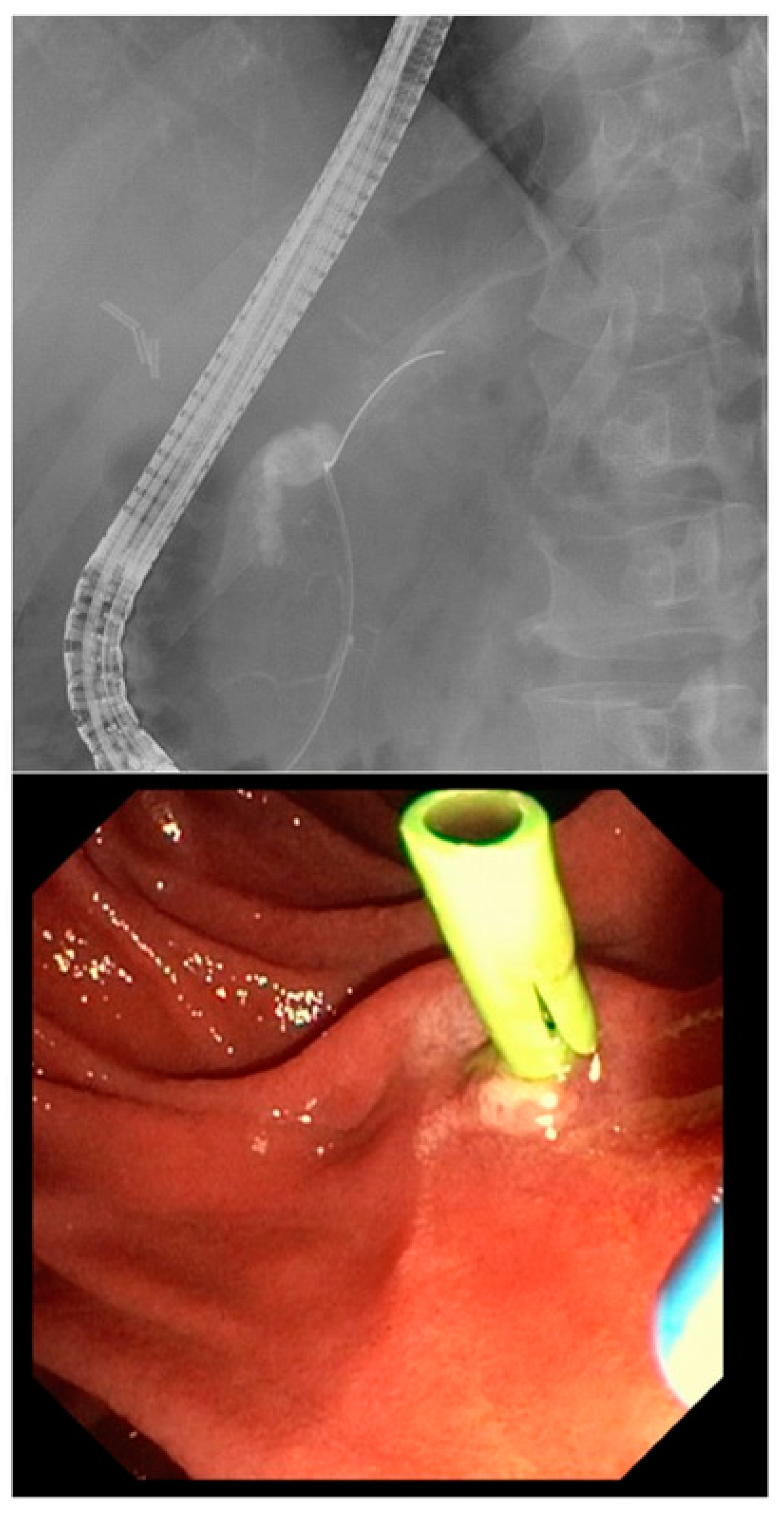 Endoscopic Transmural Therapy of Pancreatic Fistulas in an ...