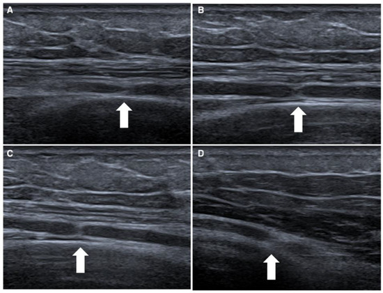 Nerve Torsion as a Pattern of Parsonage–Turner Syndrome: Literature ...