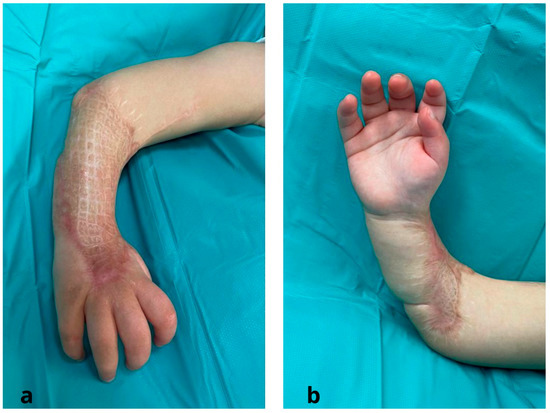 Meek Micro-Skin Grafting and Acellular Dermal Matrix in Pediatric ...