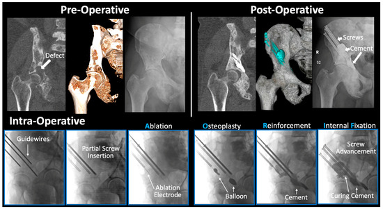 Bone Mass Changes Following Percutaneous Radiofrequency Ablation ...