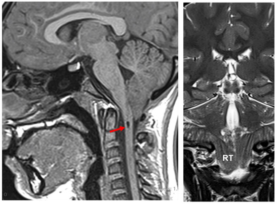 A Critical Update of the Classification of Chiari and Chiari-like ...