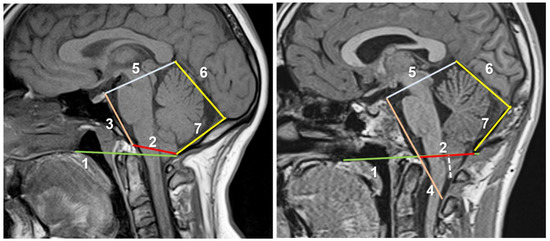 A Critical Update of the Classification of Chiari and Chiari-like ...