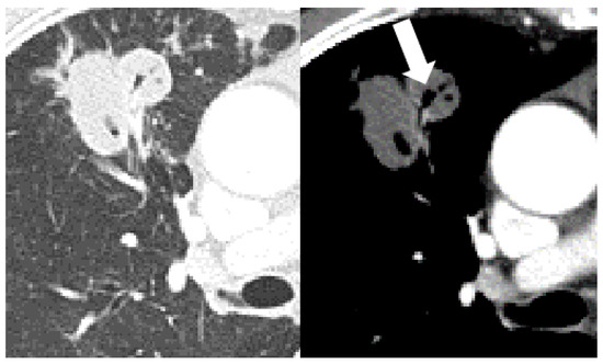 The Effect of Diabetes Control Status on CT Findings in Pulmonary ...