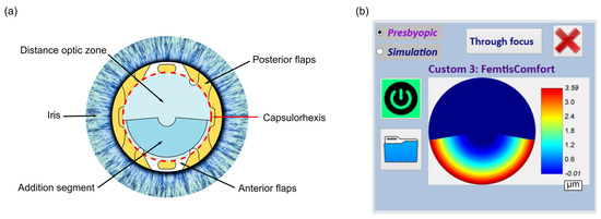 Optical Performance of a Segmented Extended-Depth-of-Focus Intraocular Lens under the Influence ...