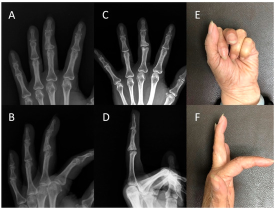 Minimum 5-Year Follow-Up Assessment of Volar Plate Interposition ...