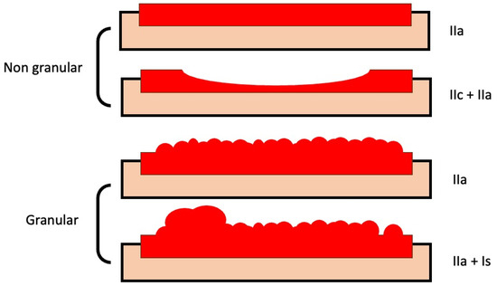 Endoscopic Submucosal Dissection, Endoscopic Mucosal Resection, and ...