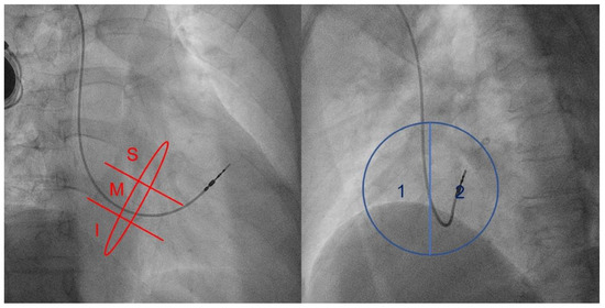 Identification of Pacemaker Lead Position Using Fluoroscopy to Avoid ...