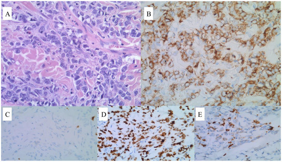Myeloid Sarcoma as a Presentation of Acute Myeloid Leukemia and Blastic ...