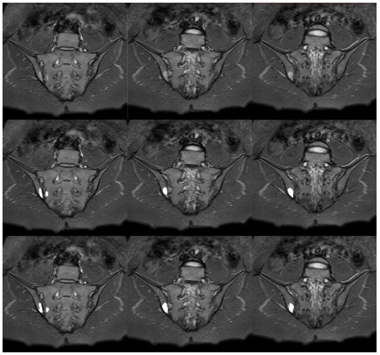 Performance of Fully Automated Algorithm Detecting Bone Marrow Edema in Sacroiliac Joints