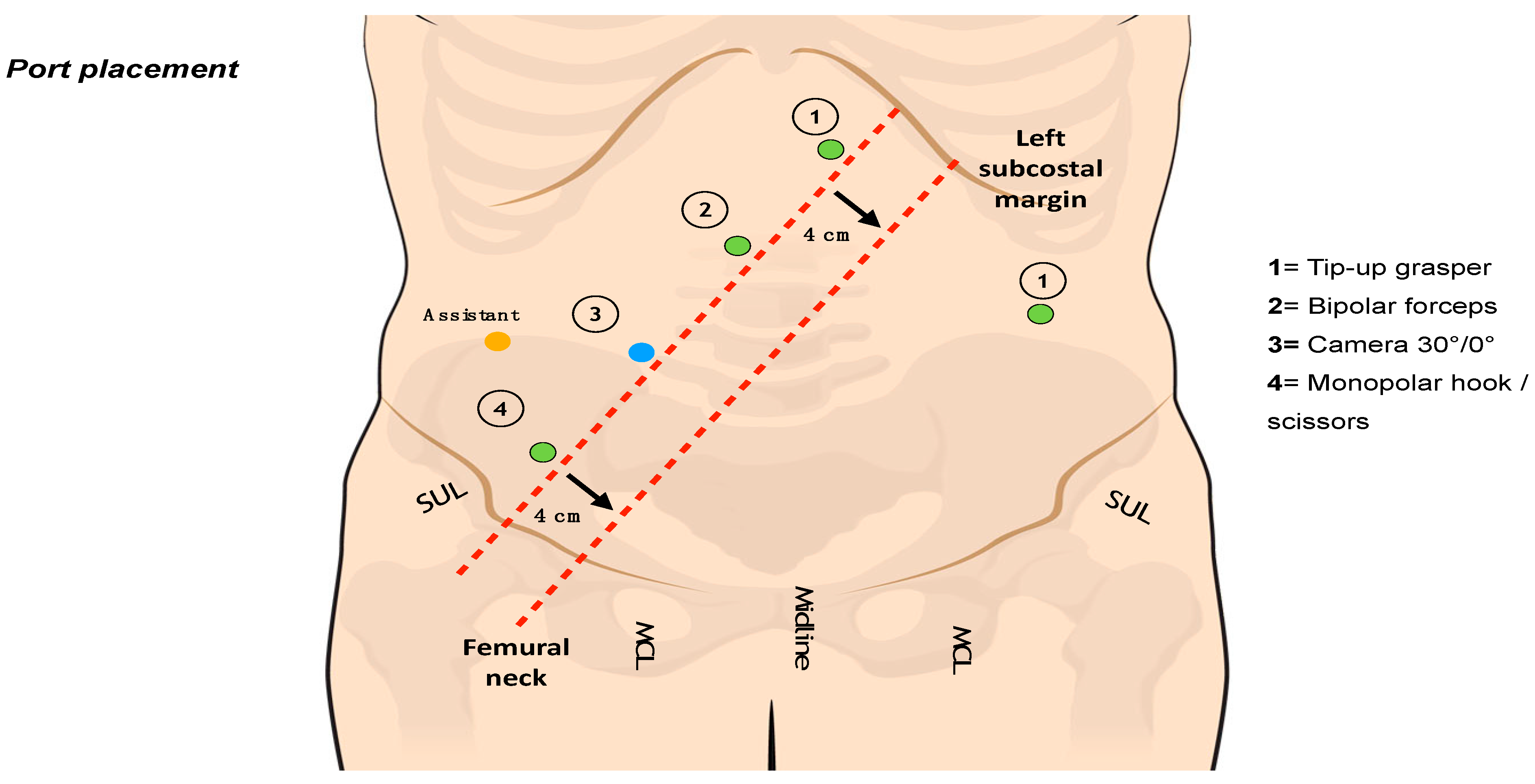 Total Mesorectal Excision