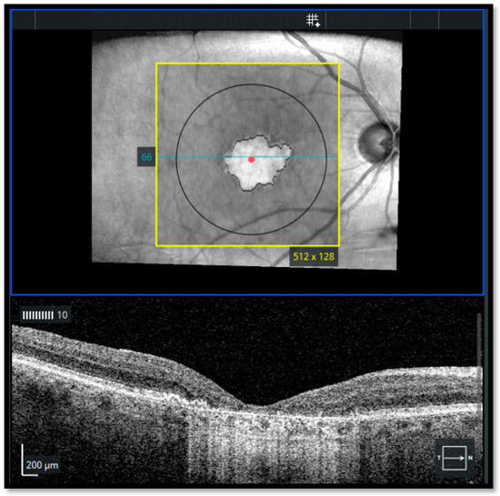 Prevalence of Geographic Atrophy in Advanced Age-Related Macular Degeneration (AMD) in Daily ...