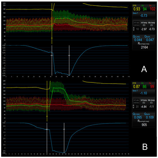Coronary Vascular (DYS) Function and Invasive Physiology Assessment: Insights into Bolus and ...
