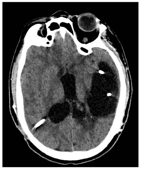 Right Transcephalic Ventriculo-Subclavian Shunt in the Surgical ...