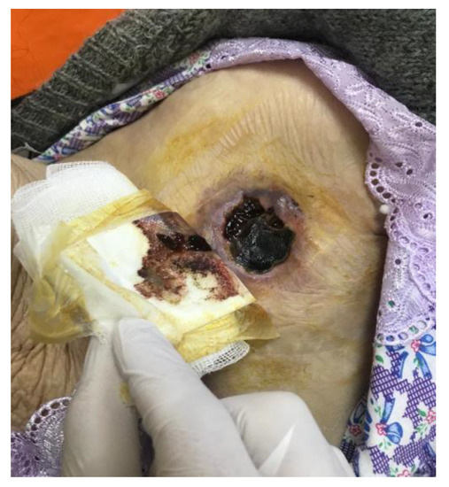 Infective Endocarditis among Pediatric Patients with Prosthetic Valves ...